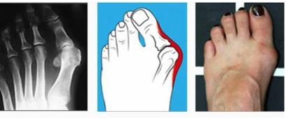 Hallux Valgus Gece Ateli Hallux Valgus Düzeltici Tedavi Aparatı ...