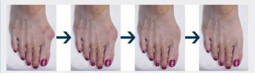 Hallux Valgus Gece Ateli Hallux Valgus Düzeltici Tedavi Aparatı ...